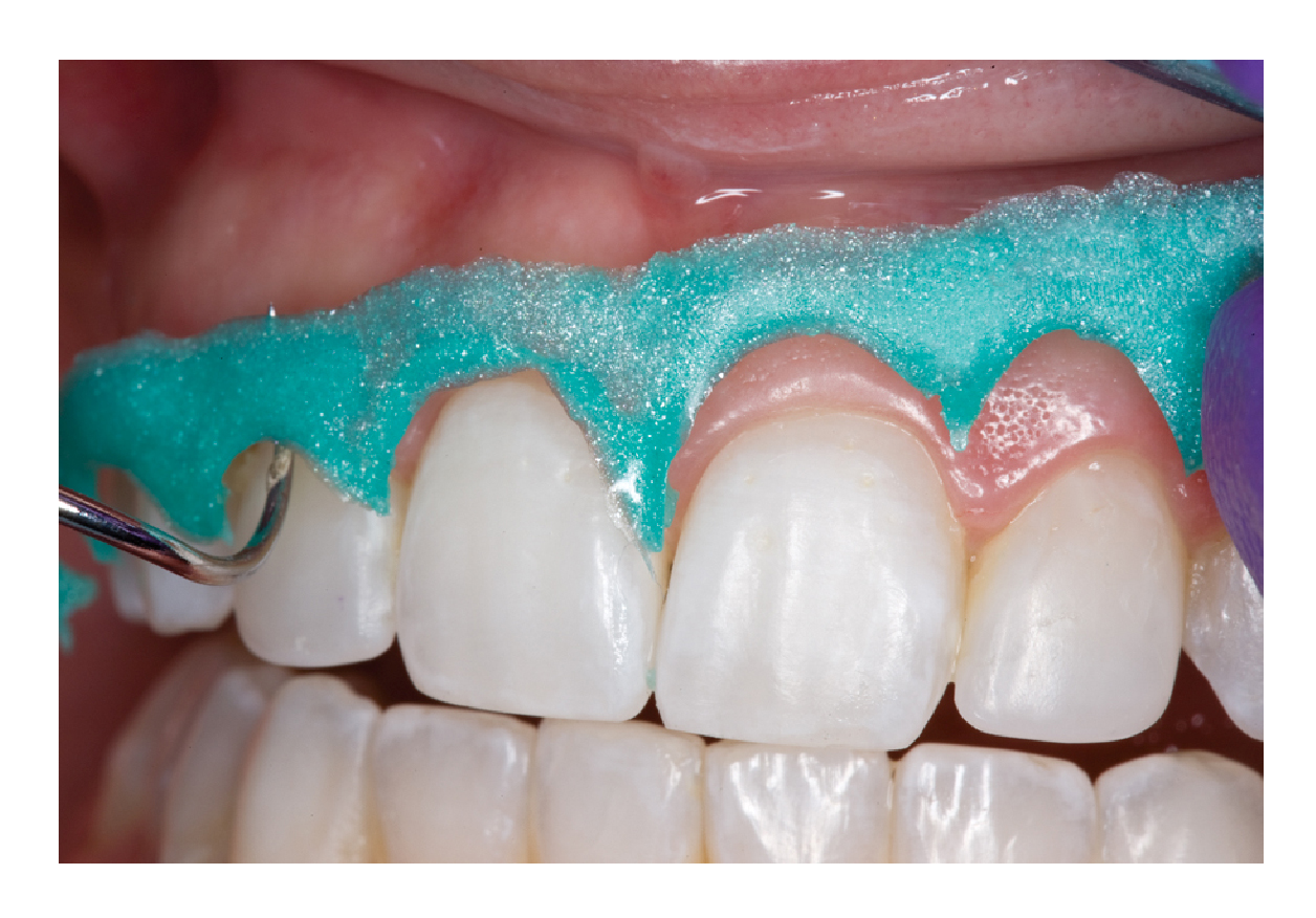 OpalDam y OpalDam Green – Barreras Gingivales de Resina | Bienvenido al ...